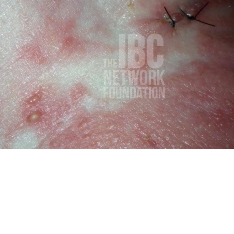 Pictures of Inflammatory Breast Cancer - The IBC Network Foundation